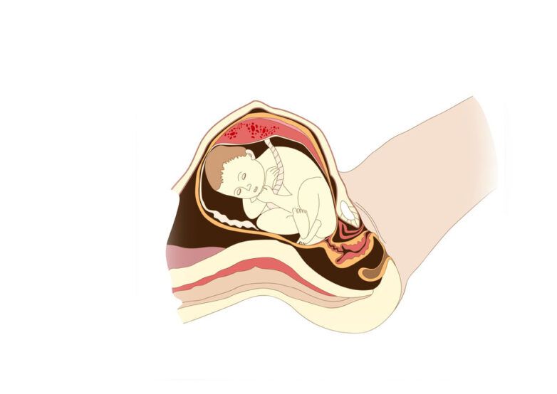 Die Steißlage: Was sie für Mama und Baby bedeutet | Babyartikel.de